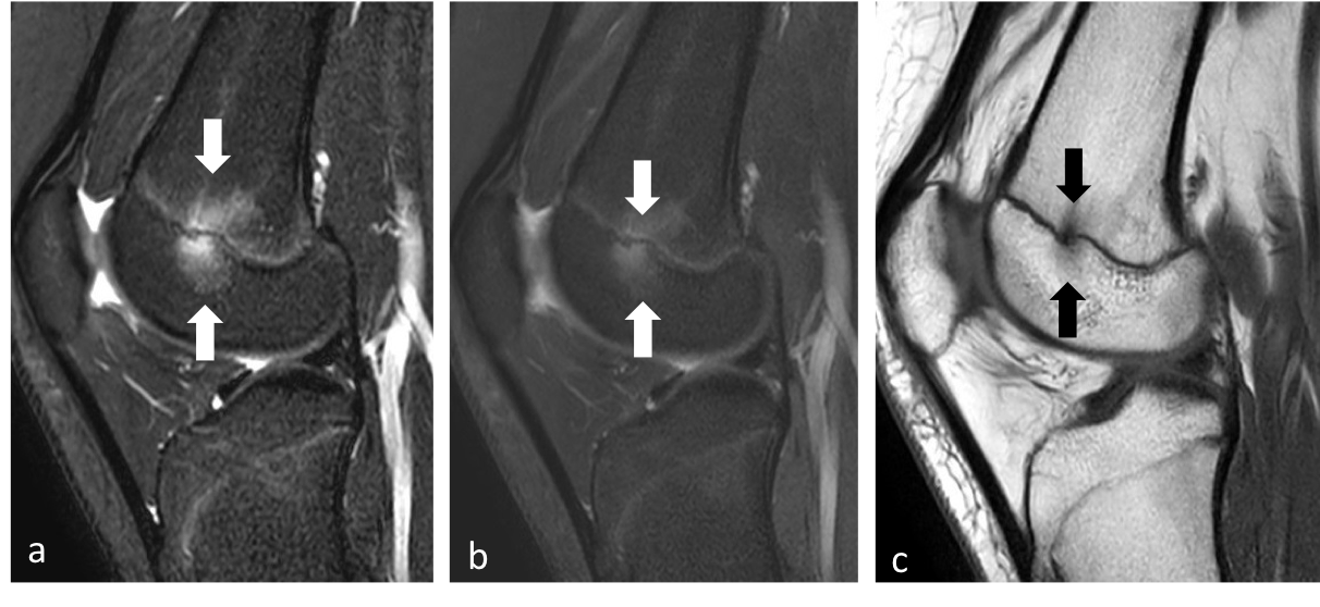 Musculoskeletal #2 – Flashcard – European Diploma of Radiology