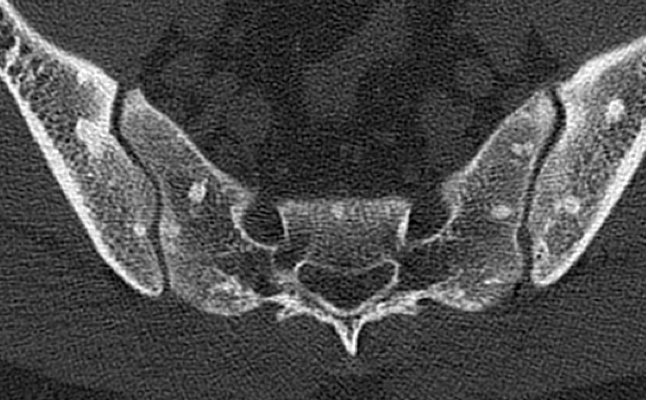 Musculoskeletal #12 – Flashcard – European Diploma of Radiology