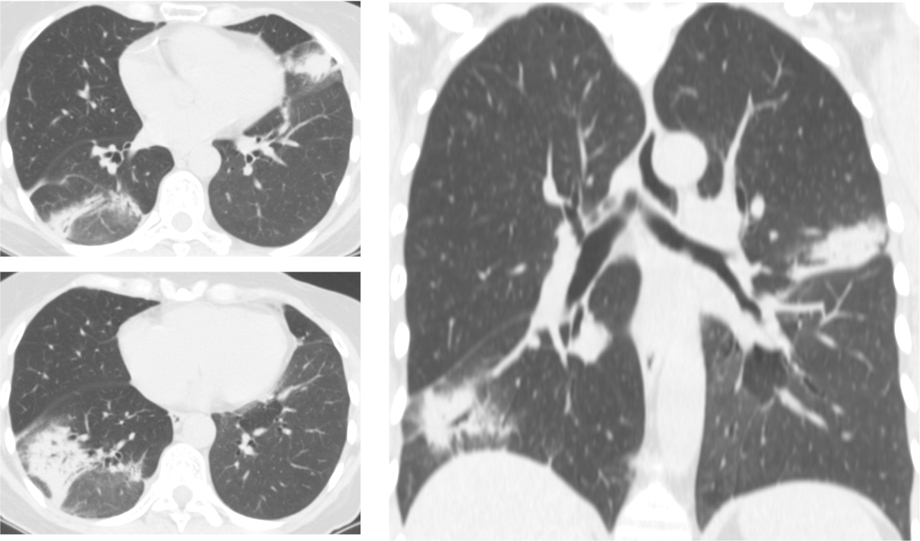 Dr. Pepe’s Diploma Casebook 170 – SOLVED – European Diploma of Radiology